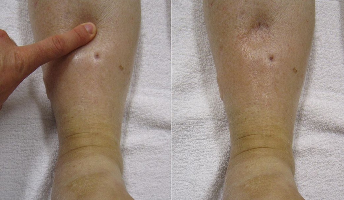 What is anasarca ?: Causes, symptoms and treatment - Padeye